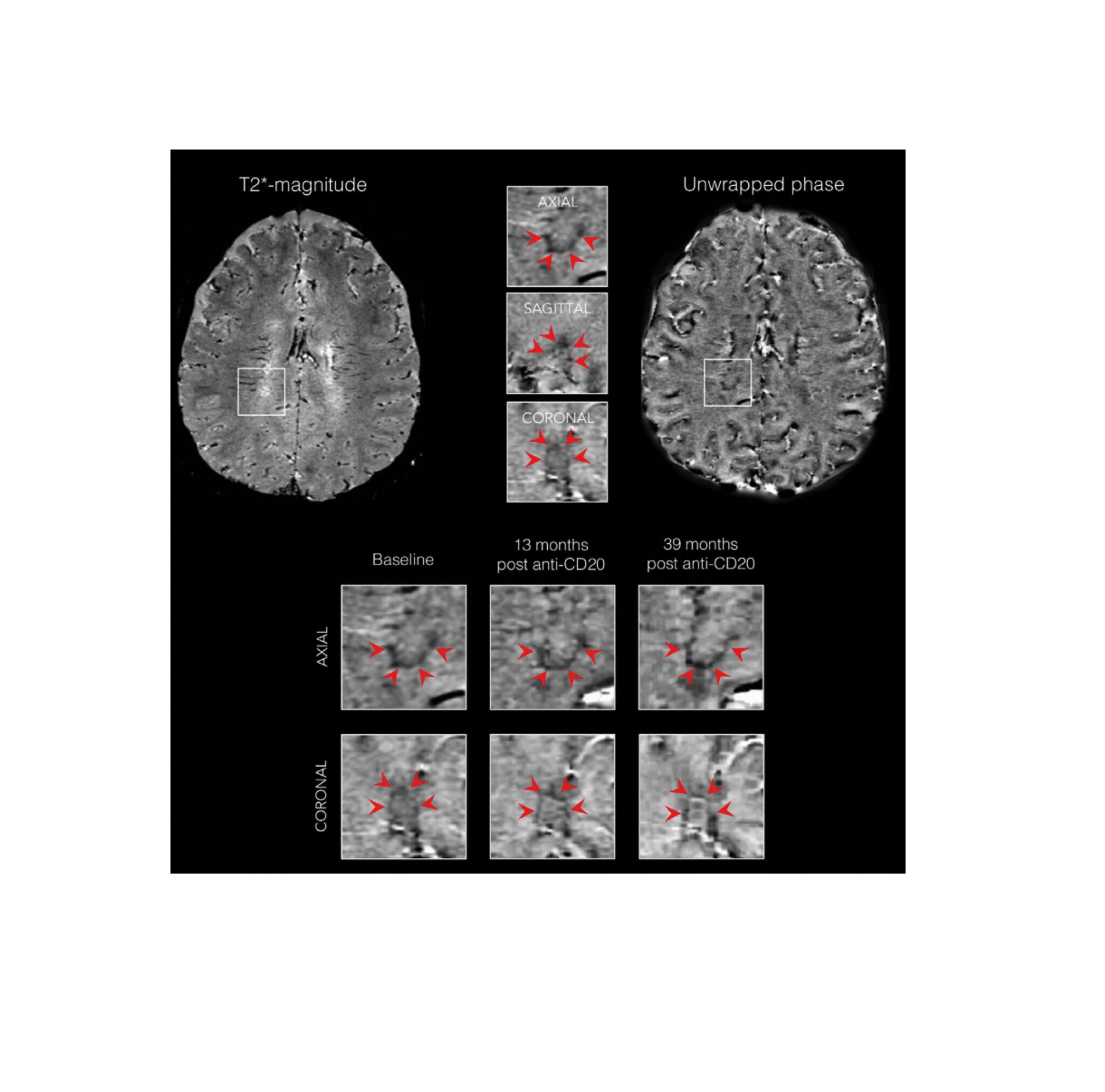 B cell depletion therapy does not resolve chronic active multiple ...
